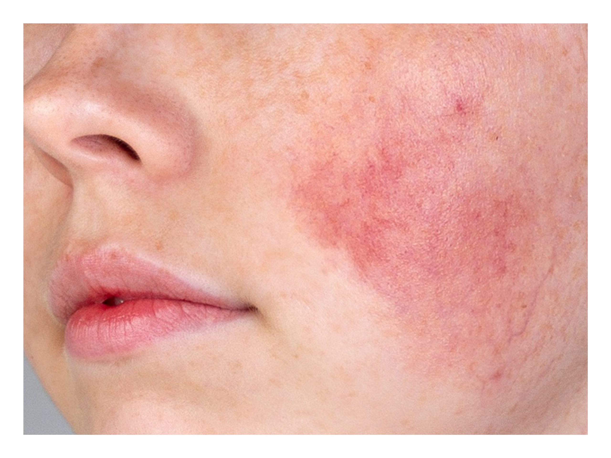 The Impact of Hard Water on Sensitive Skin: An In-Depth Analysis – Care ...